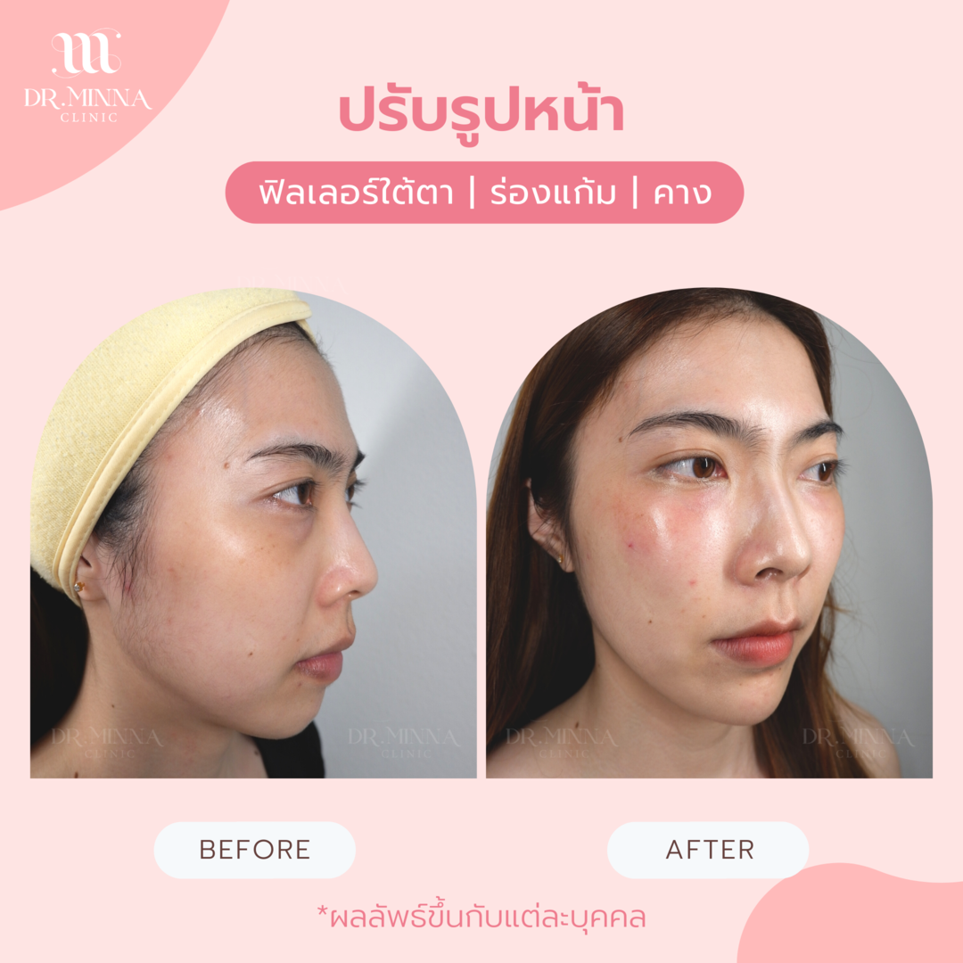 ฟิลเลอร์ (Filler) - DR.MINNA CLINIC